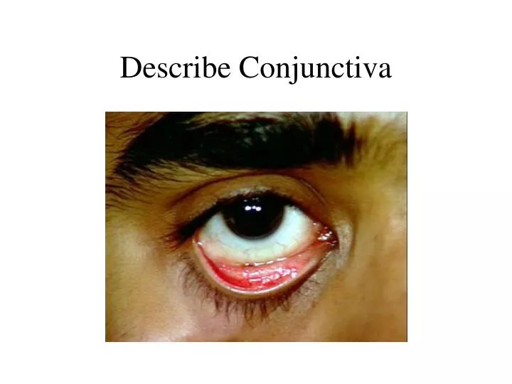 PPT - Describe Conjunctiva PowerPoint Presentation, free download - ID ...