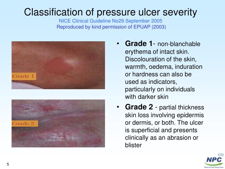 PPT - Pressure ulcers PowerPoint Presentation - ID:637307