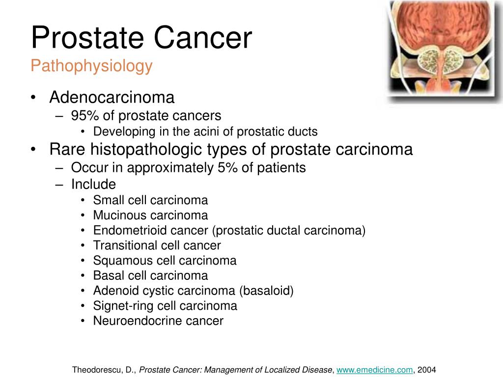 Ppt Prostate Cancer Powerpoint Presentation Free Download Id 63763