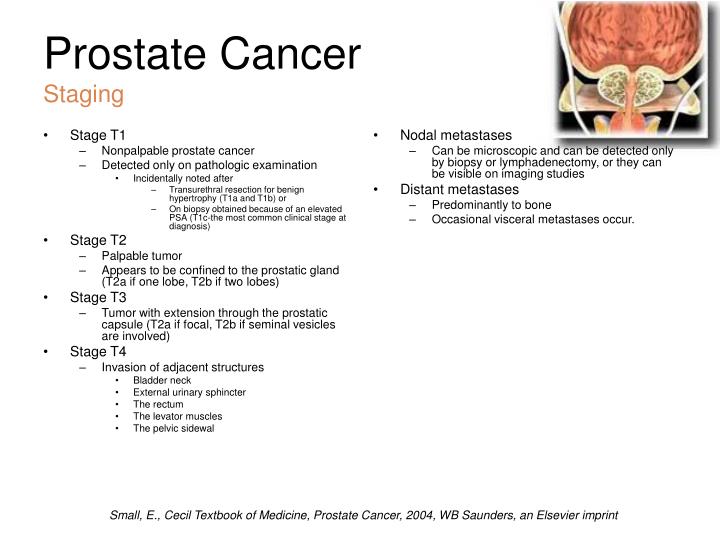PPT - Prostate Cancer PowerPoint Presentation - ID:63763