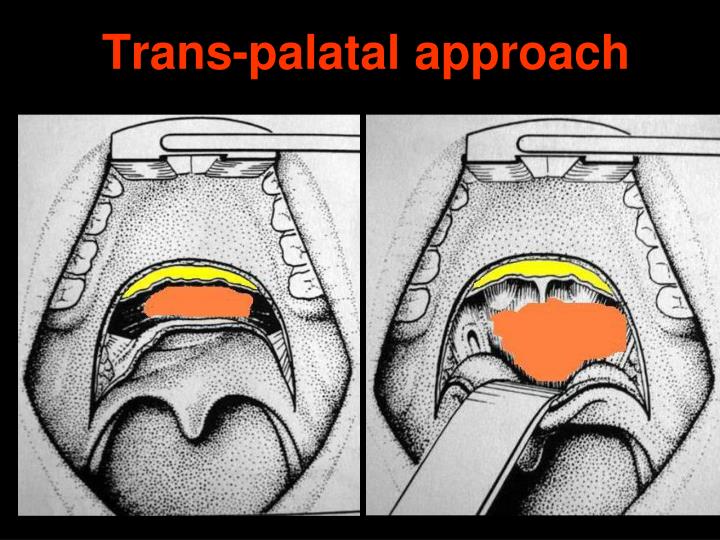 PPT - Nasopharyngeal Angiofibroma PowerPoint Presentation - ID:643867