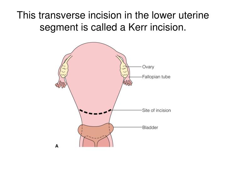 Ppt Birth Related Procedures Powerpoint Presentation Id 651536