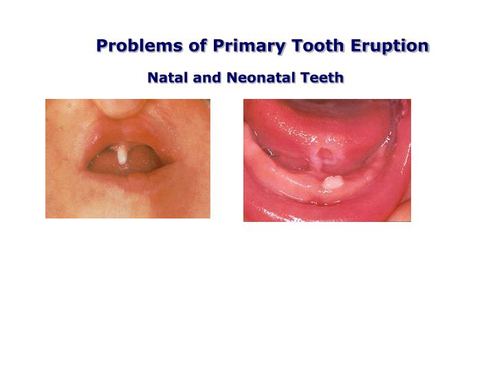 PPT - Eruption and Shedding of Teeth PowerPoint Presentation - ID:653192