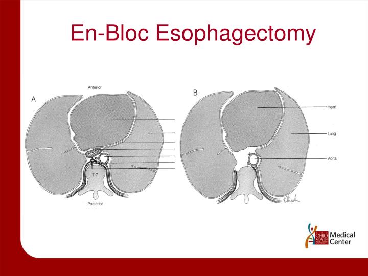 PPT - Surgical Intervention for Esophageal Cancer PowerPoint ...