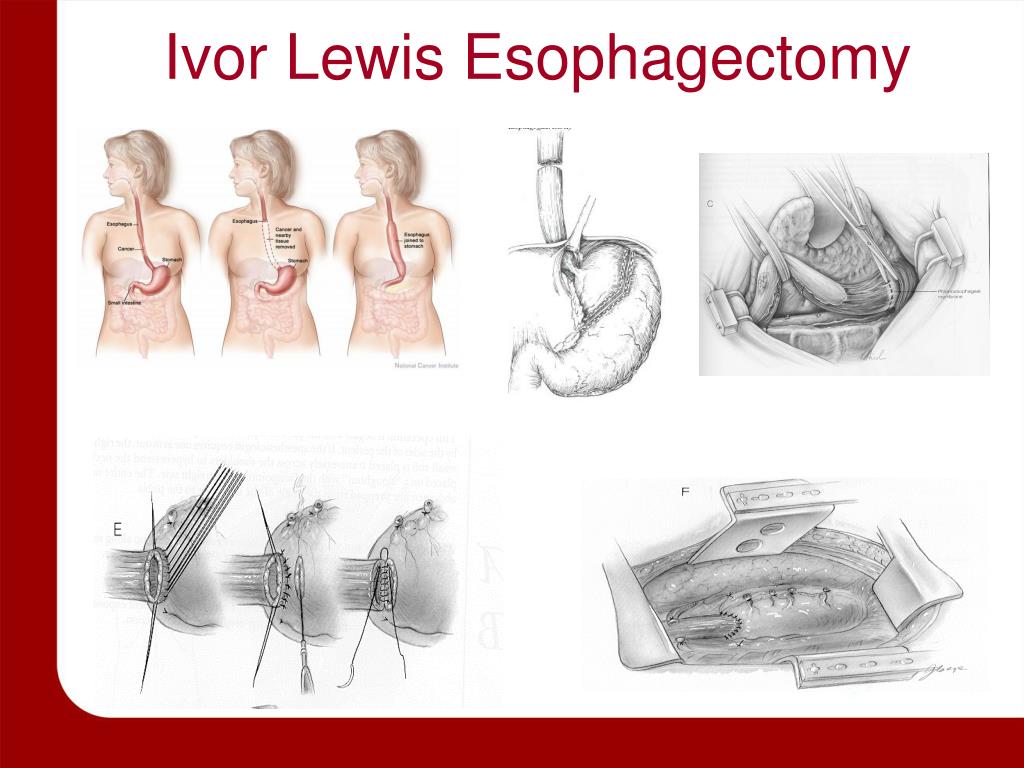 Ppt Surgical Intervention For Esophageal Cancer Powerpoint