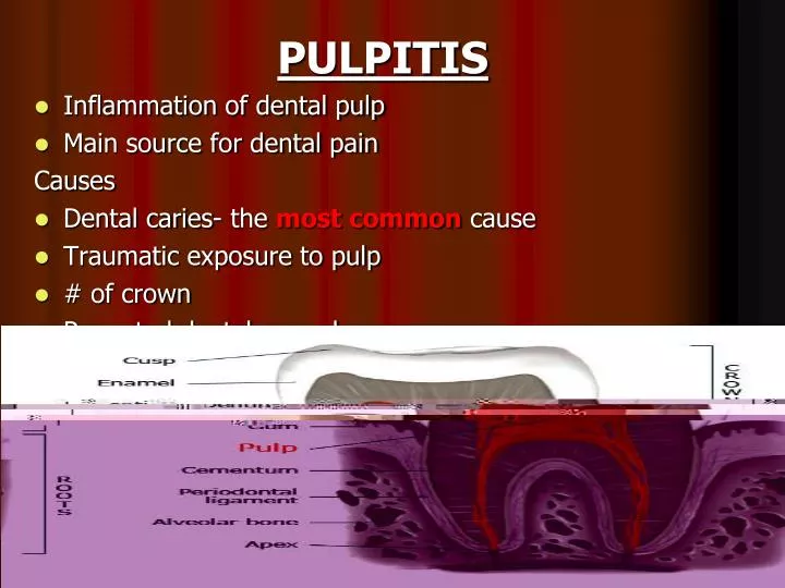 PPT - PULPITIS Inflammation of dental pulp Main source for dental pain ...