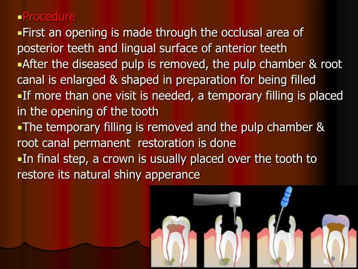 PPT - PULPITIS Inflammation of dental pulp Main source for dental pain ...