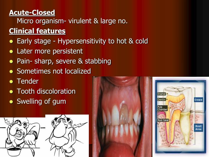 PPT - PULPITIS Inflammation of dental pulp Main source for dental pain ...