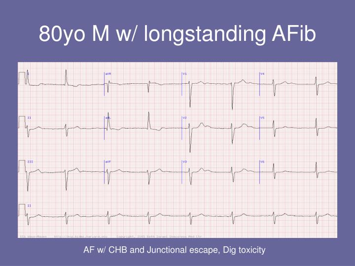 PPT - Some Interesting EKGs PowerPoint Presentation - ID:661112