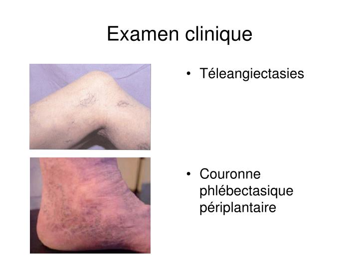 PPT - COURS SEMIOLOGIE PATHOLOGIE ANEVRISMALE PATHOLOGIE VEINEUSE ...