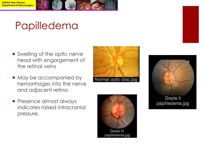 PPT - Neurosurgical Emergencies PowerPoint Presentation - ID:664626