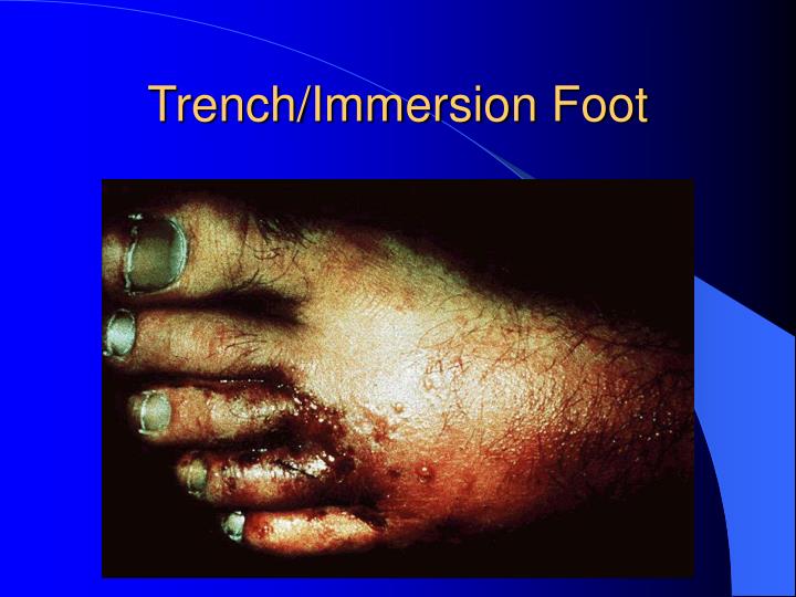 PPT - COLD INJURIES: DESCRIPTION, TREATMENT AND PREVENTION PowerPoint ...