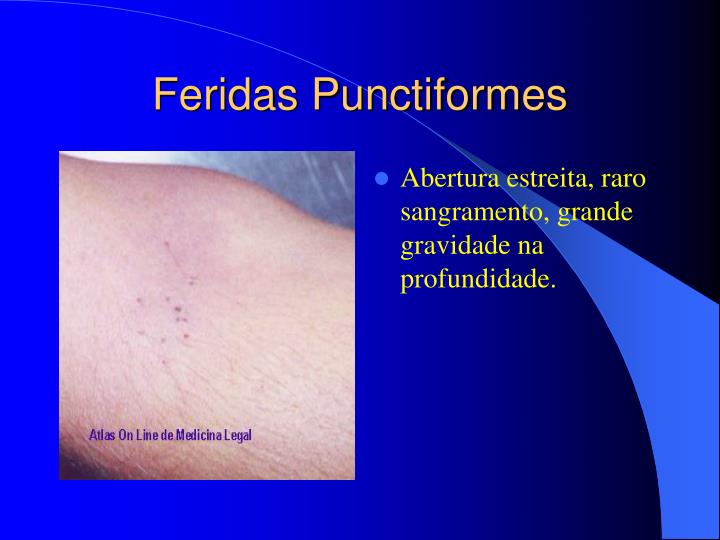 PPT - Tipos Especiais de Equimose PowerPoint Presentation - ID:667659