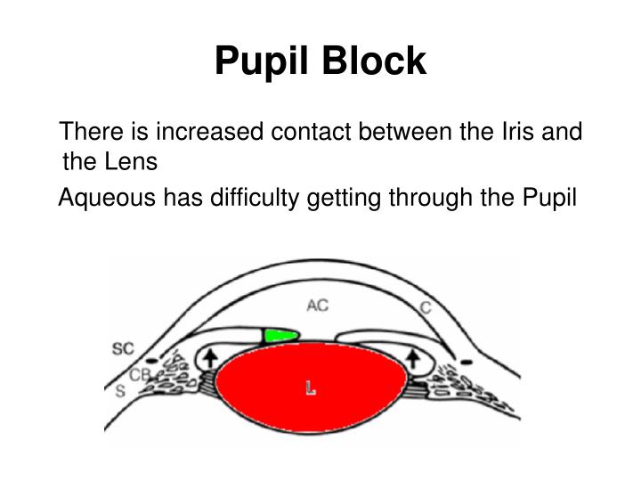 PPT - ACUTE ANGLE CLOSURE GLAUCOMA PowerPoint Presentation - ID:671613