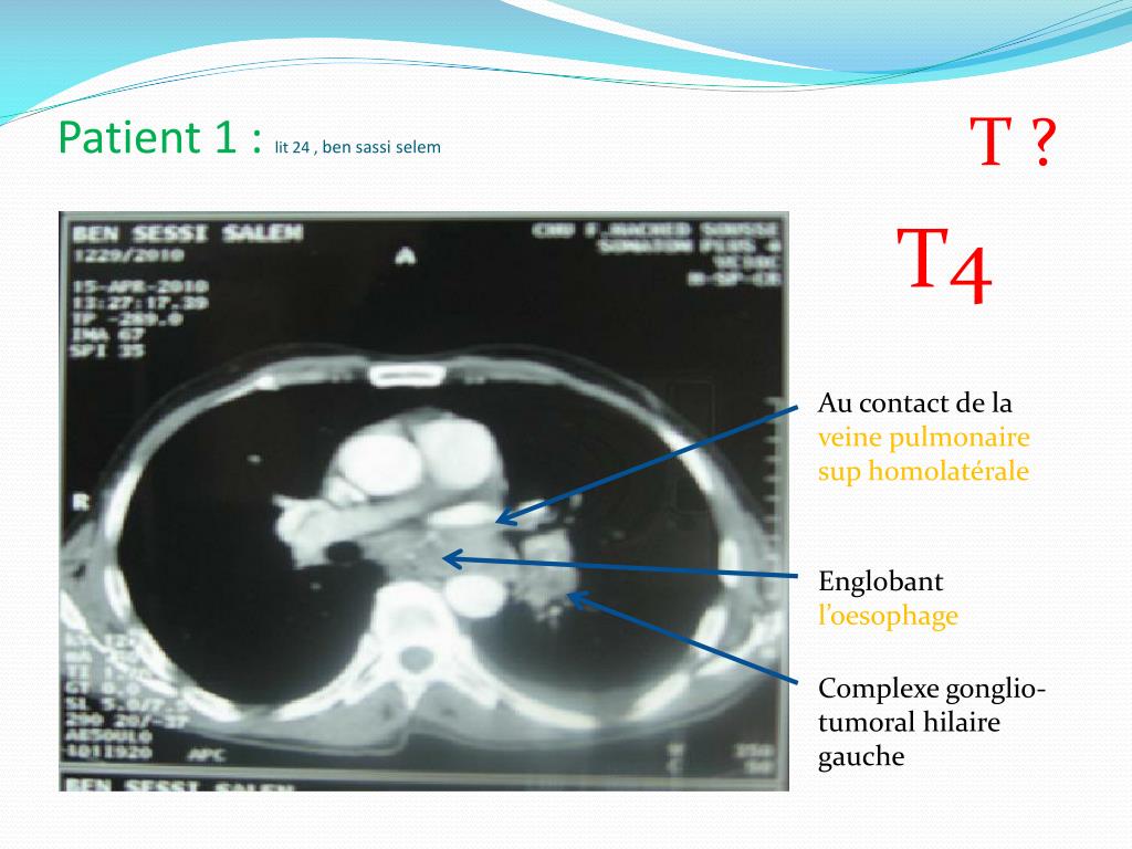 PPT - Imagerie du cancer bronchique & classification TNM PowerPoint ... PPT - Imagerie du cancer bronchique & classification TNM PowerPoint ...