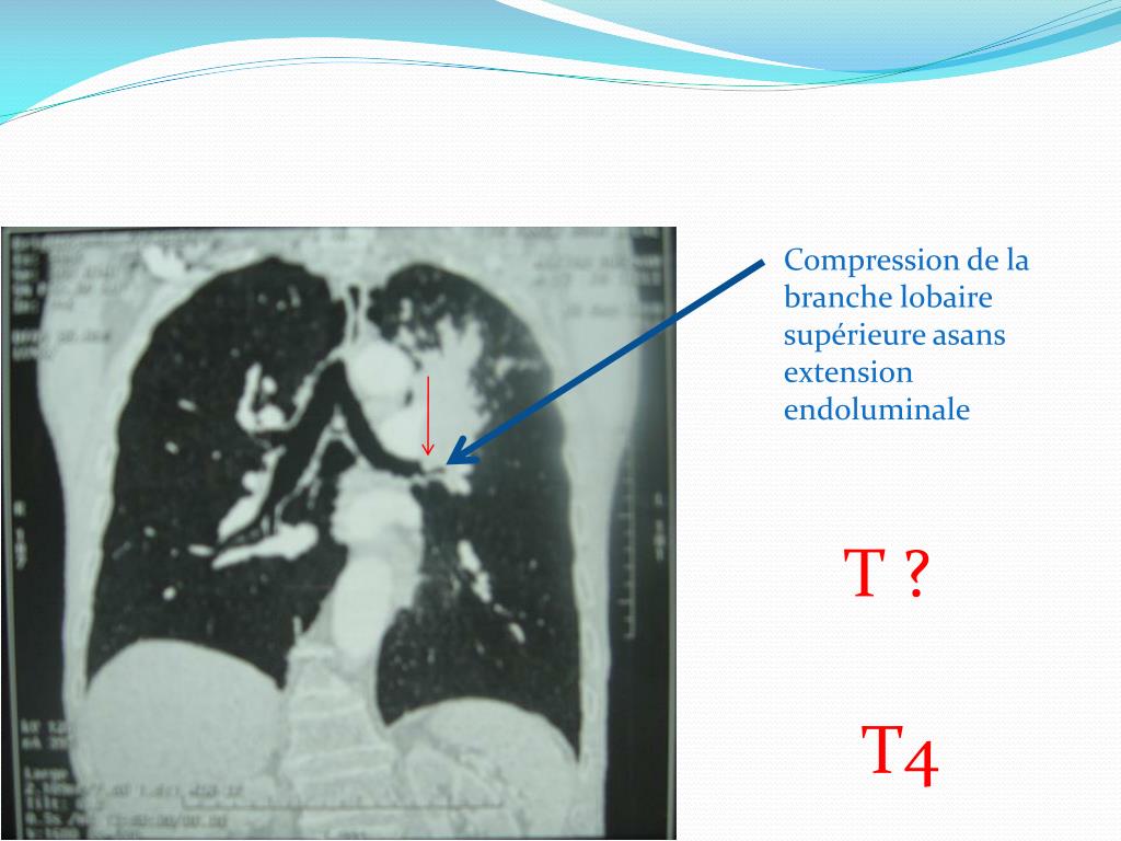 PPT - Imagerie du cancer bronchique & classification TNM PowerPoint ... PPT - Imagerie du cancer bronchique & classification TNM PowerPoint ...