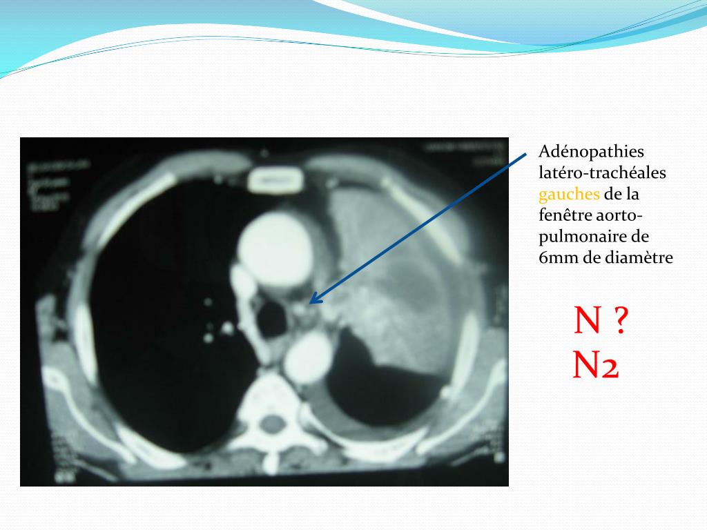 PPT - Imagerie du cancer bronchique & classification TNM PowerPoint ... PPT - Imagerie du cancer bronchique & classification TNM PowerPoint ...