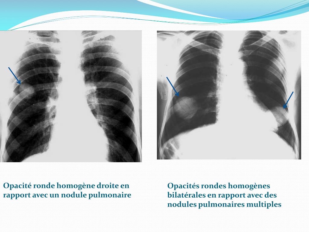 PPT - Imagerie du cancer bronchique & classification TNM PowerPoint ... PPT - Imagerie du cancer bronchique & classification TNM PowerPoint ...