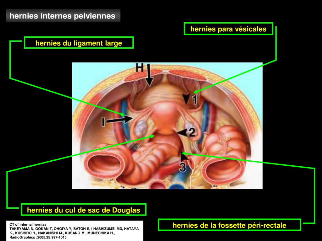 PPT - les hernies internes ; petite promenade (récréative mais "chi…te"…!) PowerPoint ...