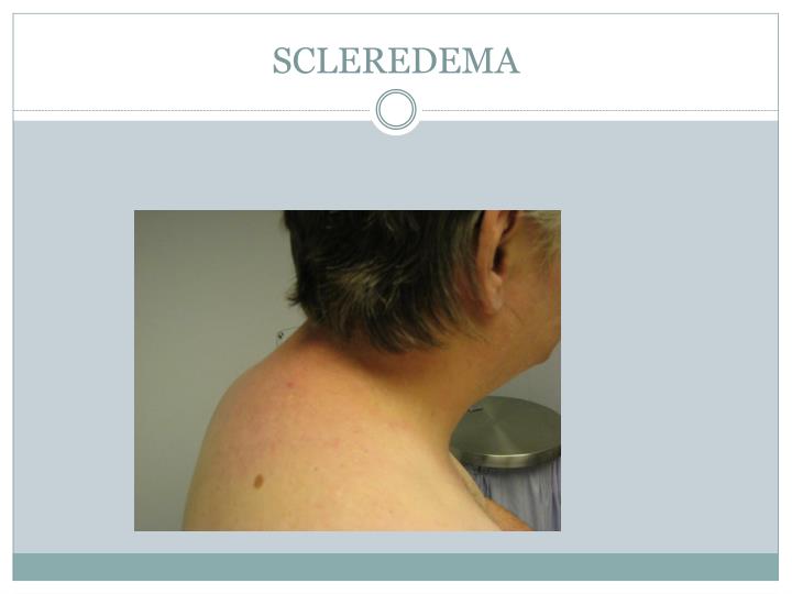 PPT - Scleromyxedema PowerPoint Presentation - ID:676666