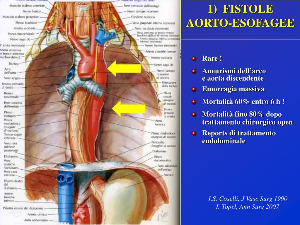 PPT - MECCANISMI FISIOPATOLOGICI NELLE EMORRAGIE DIGESTIVE DA LESIONE ...