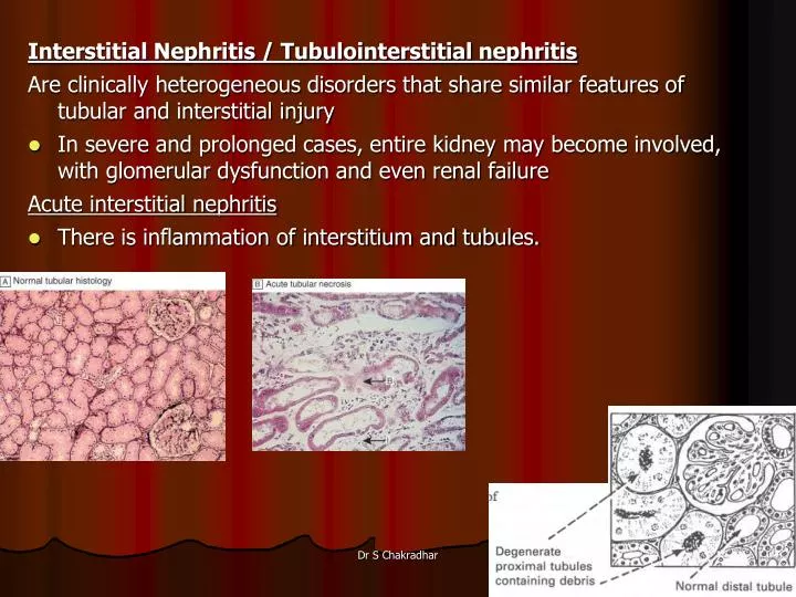 PPT - Interstitial Nephritis / Tubulointerstitial nephritis Are ...