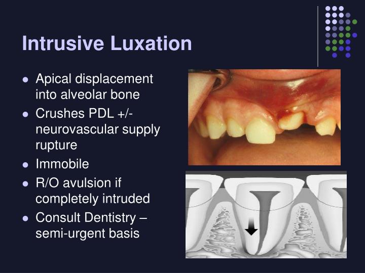 PPT - Dental Trauma in the ED: Fractures and Luxations PowerPoint ...