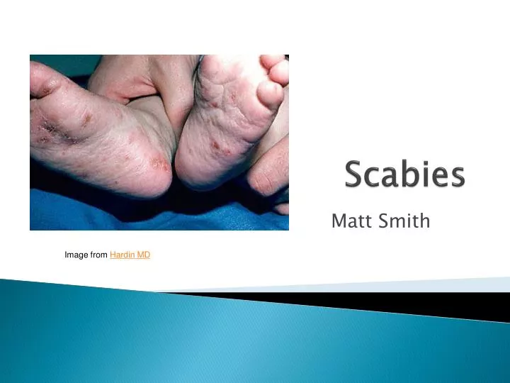 PPT - Scabies PowerPoint Presentation, free download - ID:682039