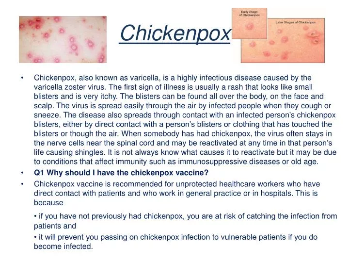 PPT - Chickenpox PowerPoint Presentation, free download - ID:684386