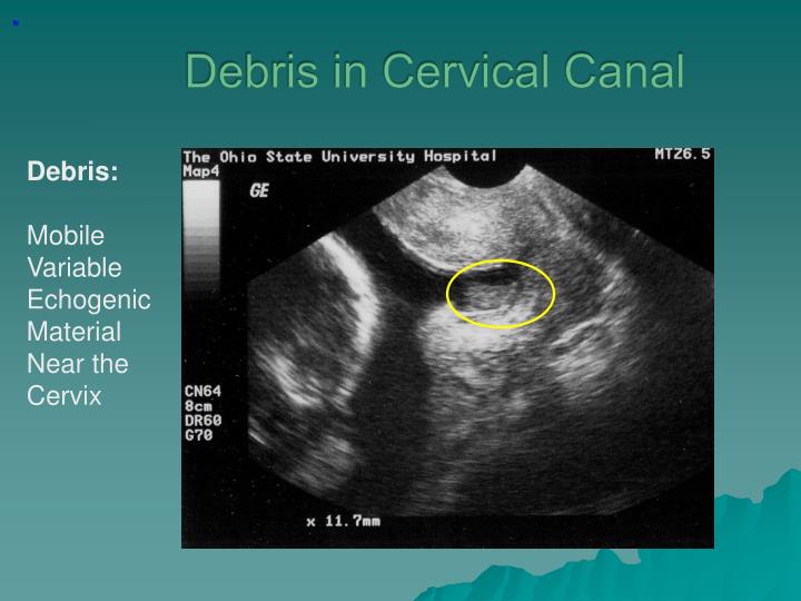 PPT - Cervical Insufficiency (Cervical Incompetence) aka “too easy out ...