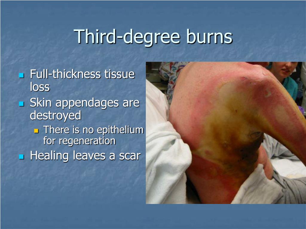 3rd Degree Burn Healing Time Kizacanadian