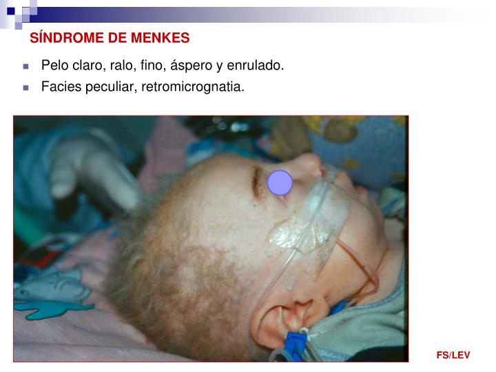 PPT - SÍNDROME DE MENKES PRINCIPALES CARACTERÍSTICAS MENKES DISEASE ...