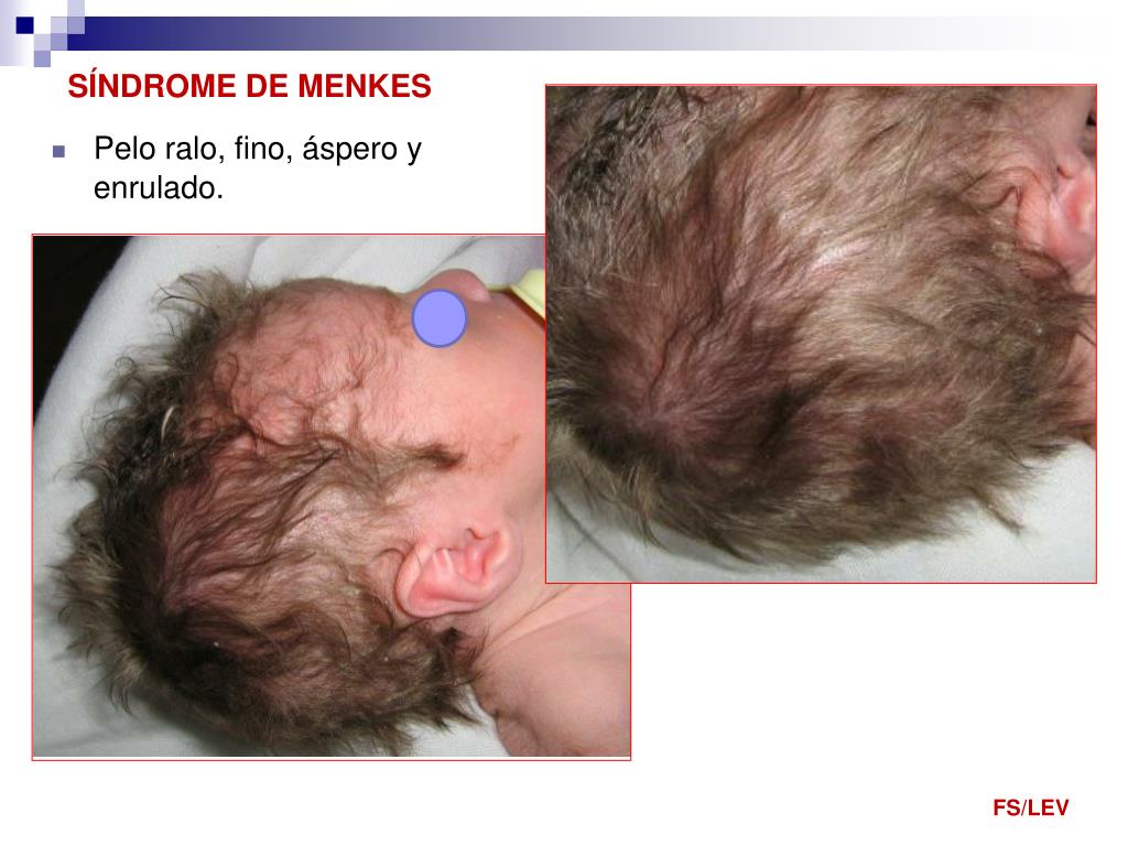 PPT - SÍNDROME DE MENKES PRINCIPALES CARACTERÍSTICAS MENKES DISEASE ...