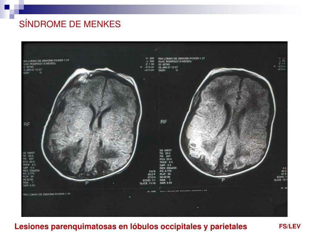 PPT - SÍNDROME DE MENKES PRINCIPALES CARACTERÍSTICAS MENKES DISEASE ...