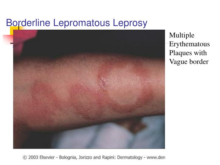 PPT - Mycobacteria: Tuberculosis and Leprosy PowerPoint Presentation ...