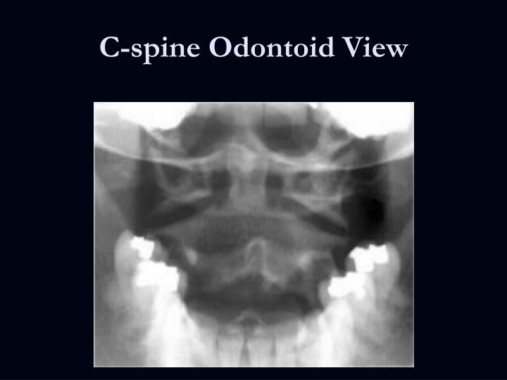 PPT - Traumatic Spine and Spinal Cord Injuries PowerPoint Presentation ...