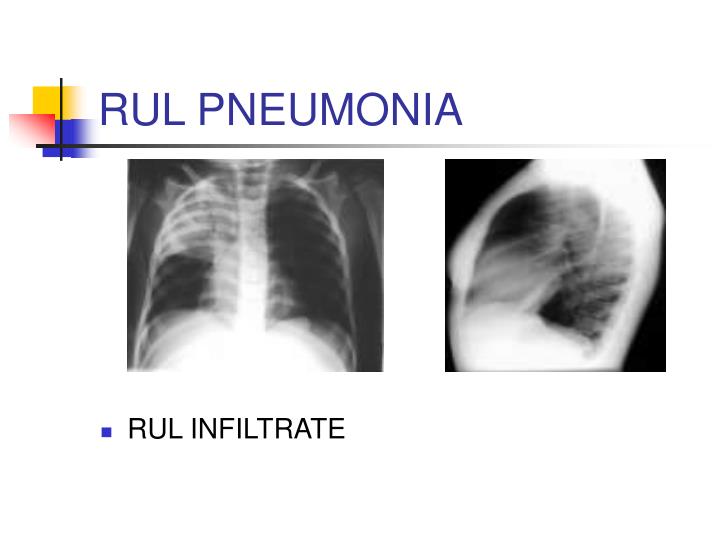 PPT - CHEST PAIN PowerPoint Presentation - ID:70554