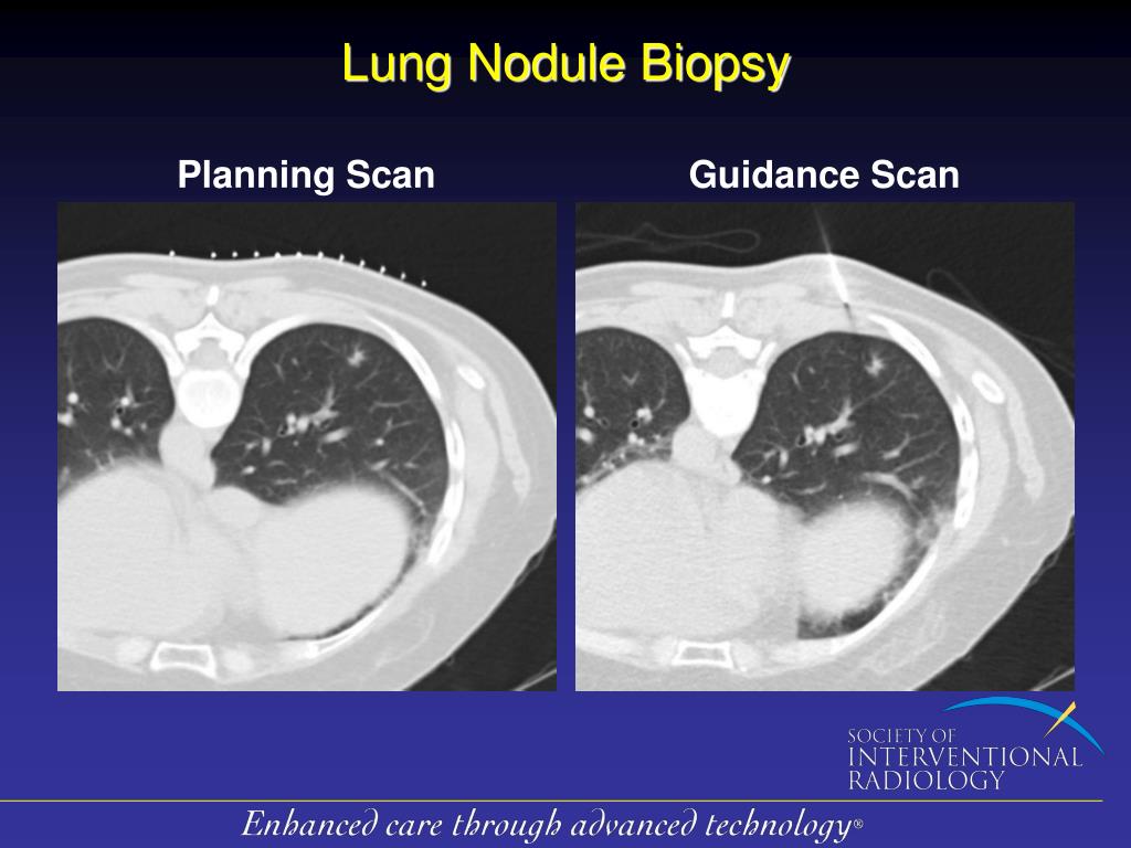 Lung Nodule Biopsy