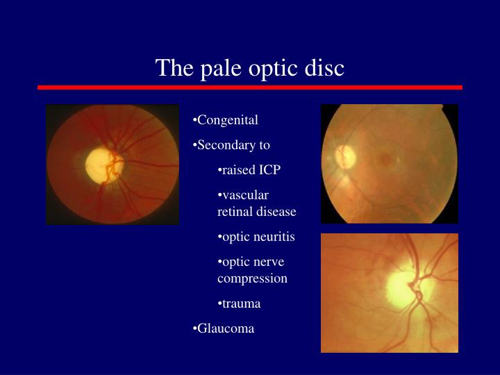 PPT - NEURO-OPHTHALMOLOGY PowerPoint Presentation - ID:707507