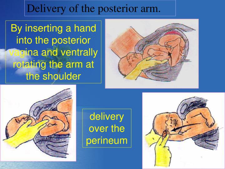 PPT - Shoulder dystocia PowerPoint Presentation - ID:709349