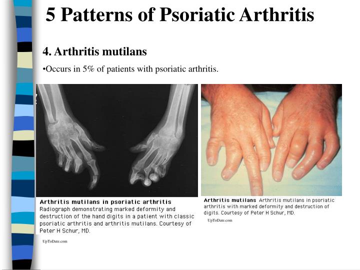 PPT - Psoriatic Arthritis PowerPoint Presentation - ID:71148