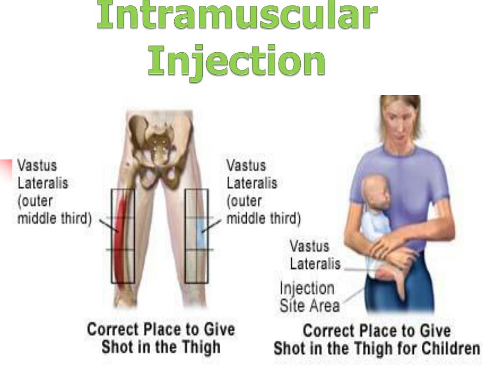 Intramuscular Injection Sites Intramuscular Injection - vrogue.co Intramuscular Injection Sites Intramuscular Injection - vrogue.co