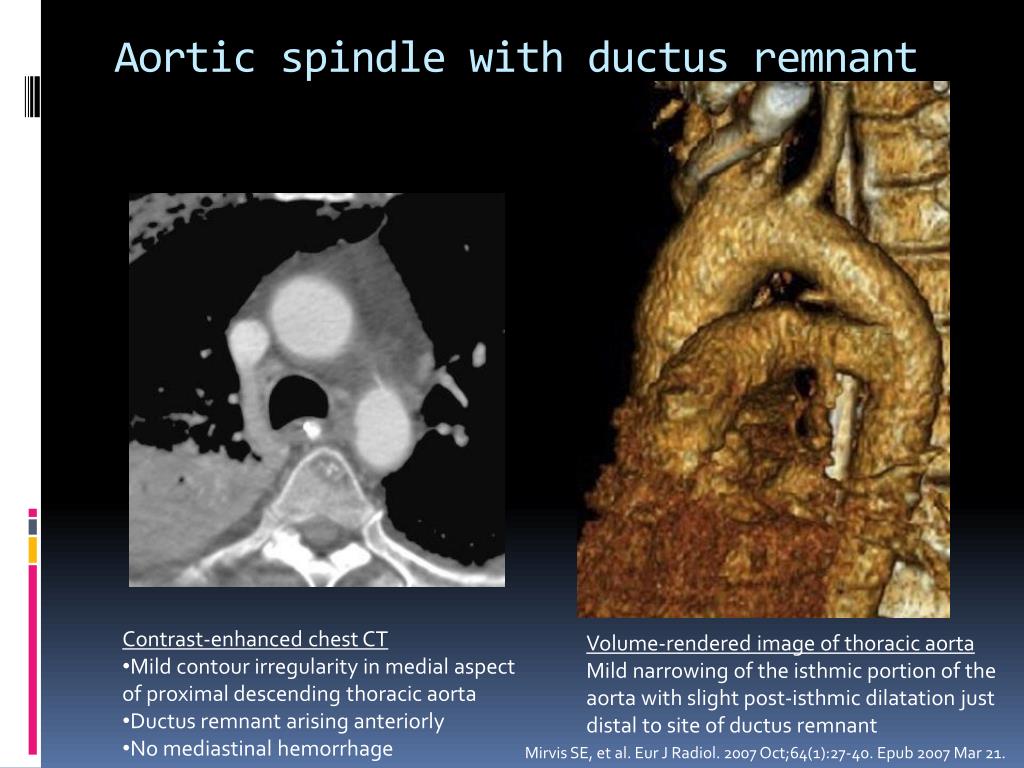 PPT - MDCT & MRI Pictorial Review of Blunt Traumatic Aortic Injury ...