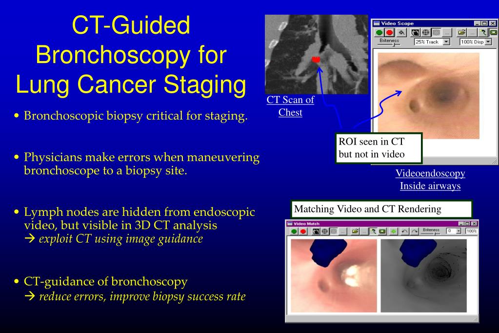 Ppt Ct Video Registration Accuracy For Virtual Guidance Of Bronchoscopy Powerpoint