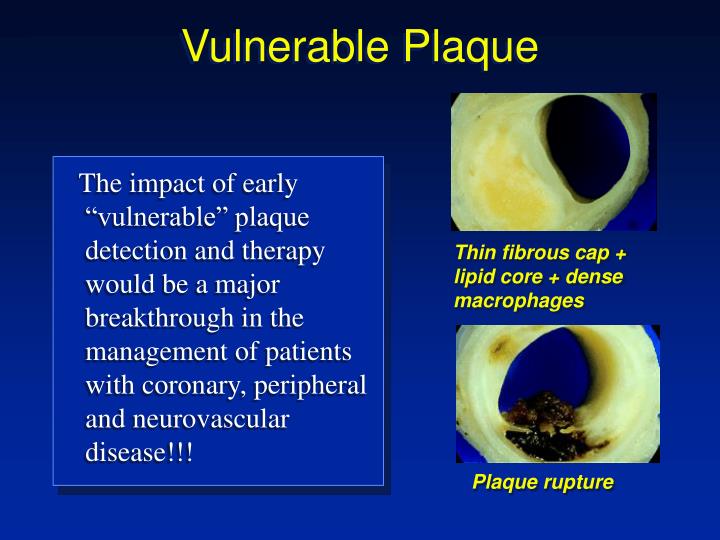 PPT - Vulnerable Plaque PowerPoint Presentation - ID:724253