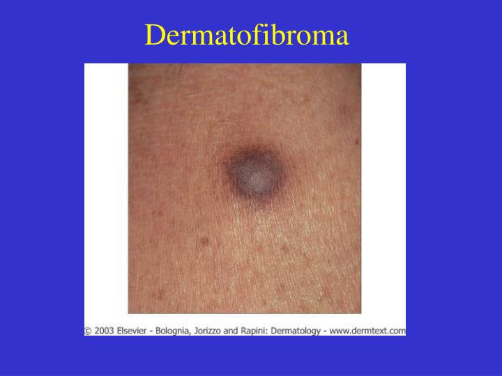 PPT - Dermal and Subcutaneous Tumors – Part II PowerPoint Presentation ...