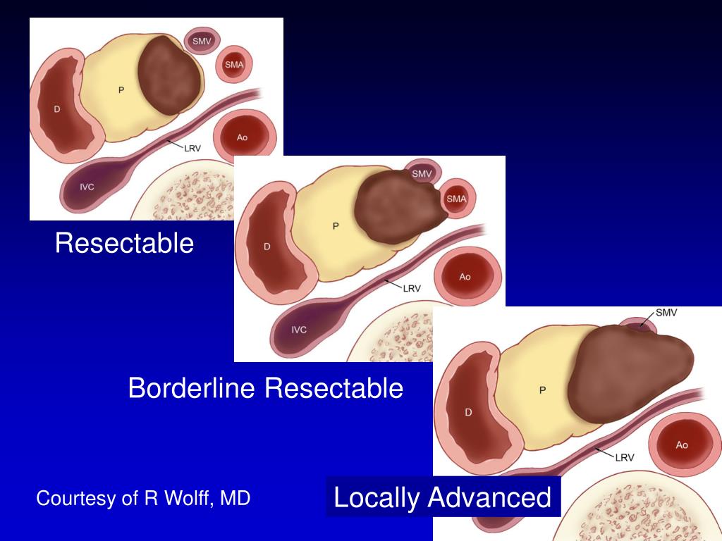 PPT - Pancreatic cancer: What defines resectability and the role for ...