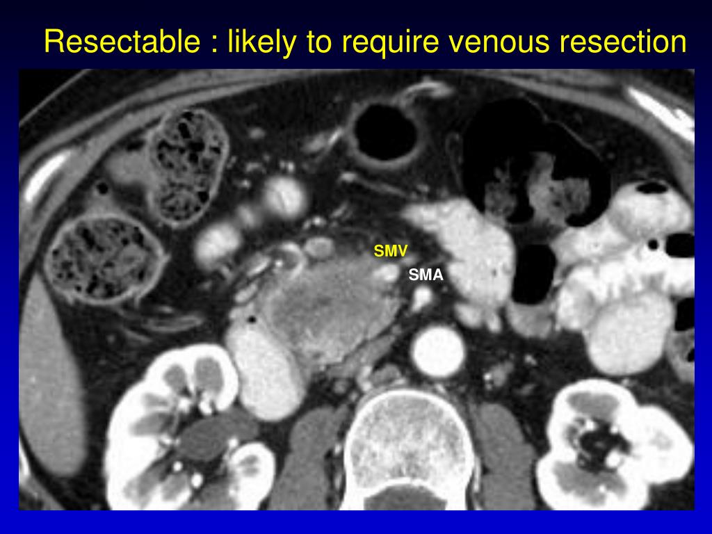 PPT - Pancreatic cancer: What defines resectability and the role for ...