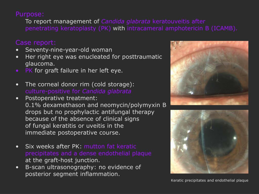 PPT - Intracameral Amphotericin B in Management of Candida Glabrata ...