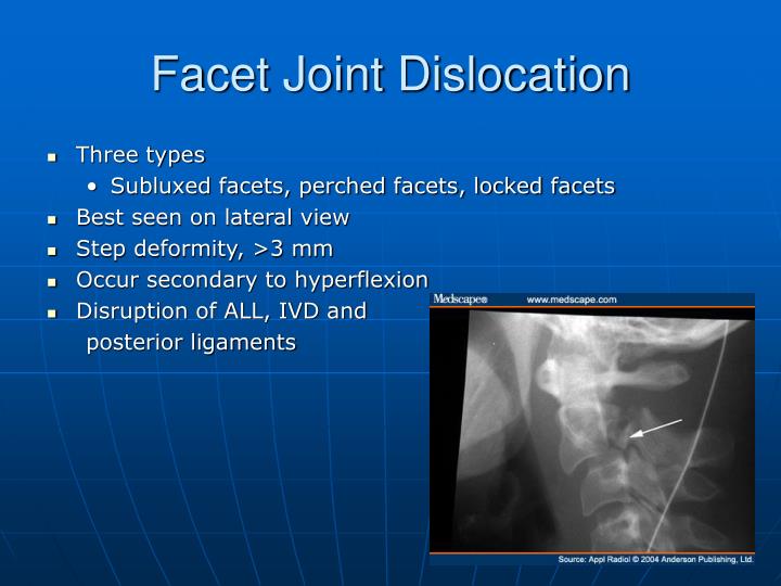 PPT - Cervical Spine PowerPoint Presentation - ID:732240